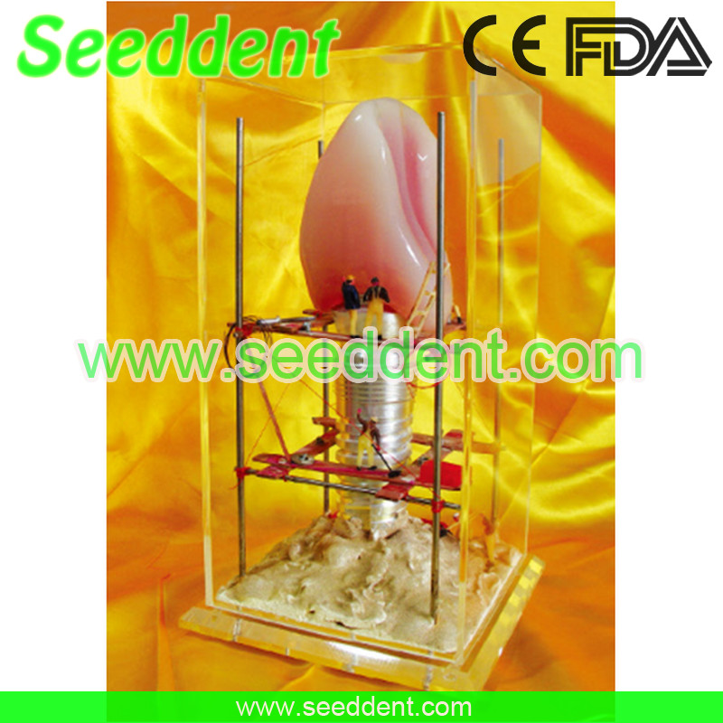 SHOW-case big implant